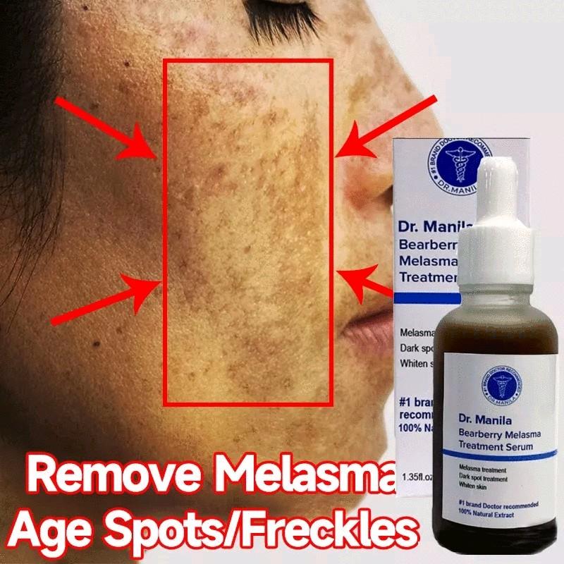 Dr. Manila Melasma Treatment Serum Bearberry (Authentic) All - TikTok ...